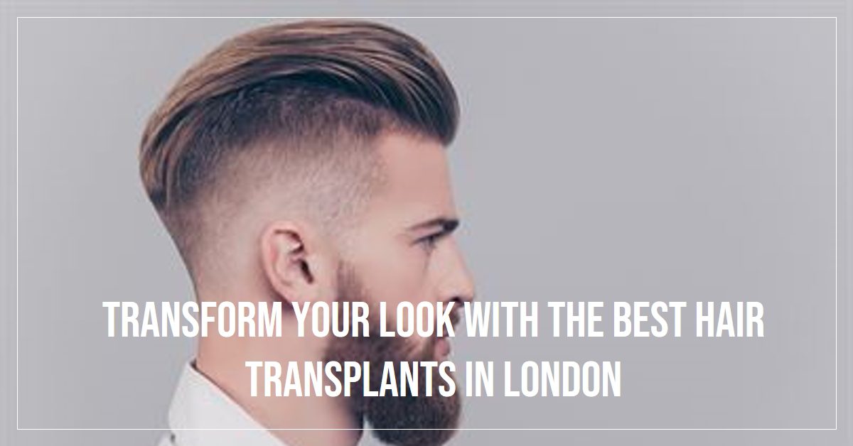 Best Hair Transplants In London (2025)